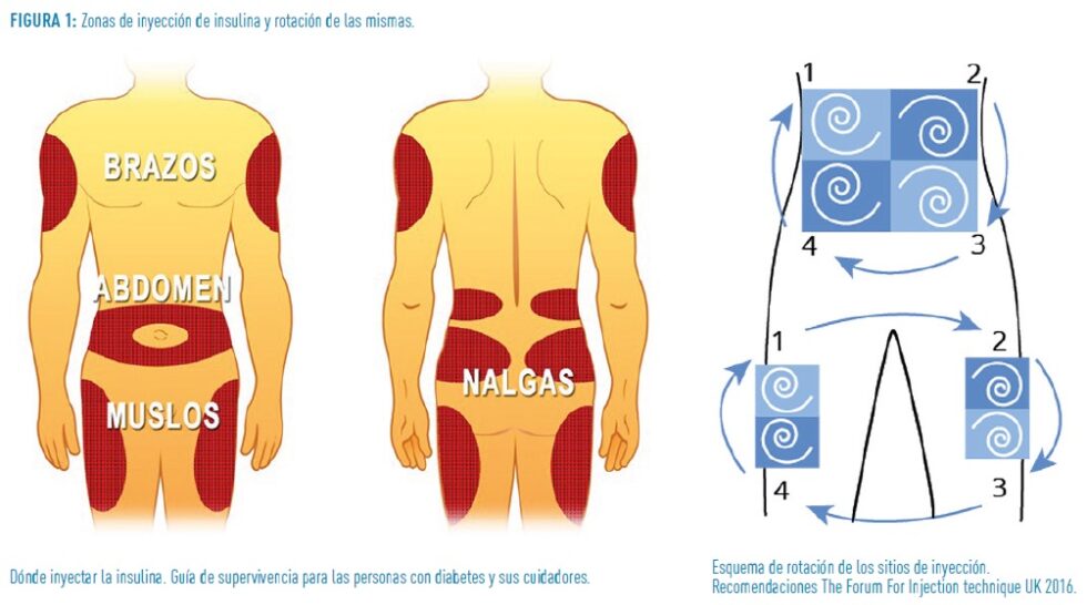 Importancia de la técnica de auto inyección de insulina - Revista Diabetes